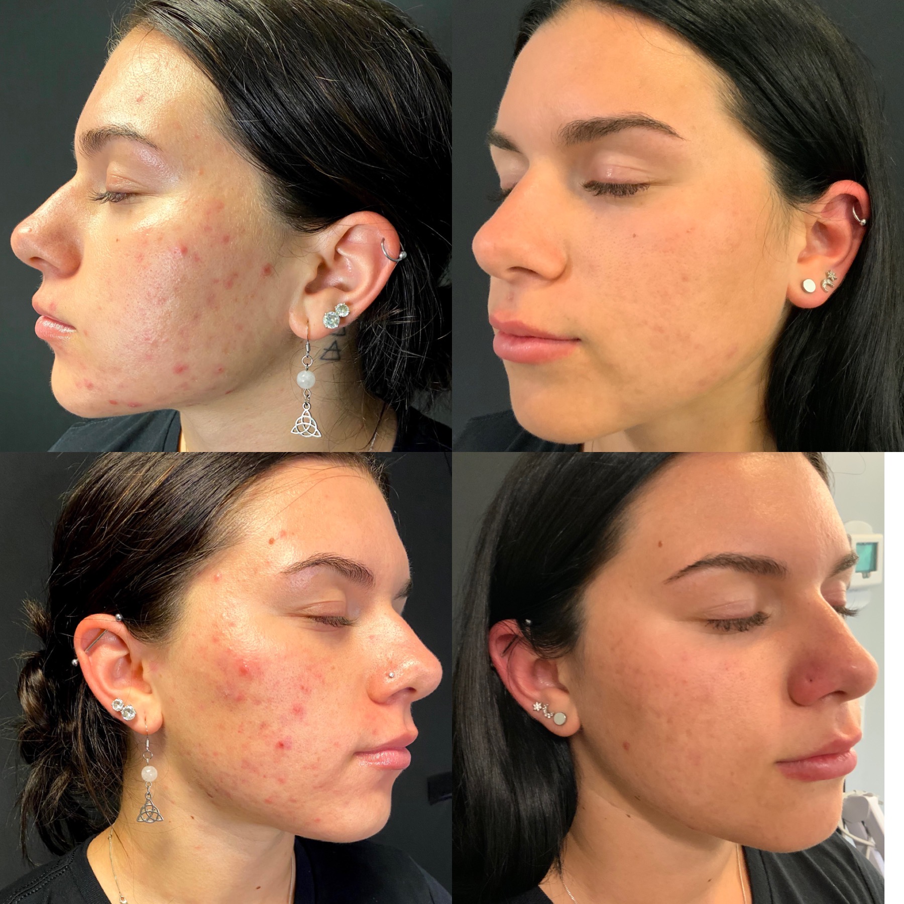 Non Surgical Breast Lift in Medina | Radiant Divine Medical Spa