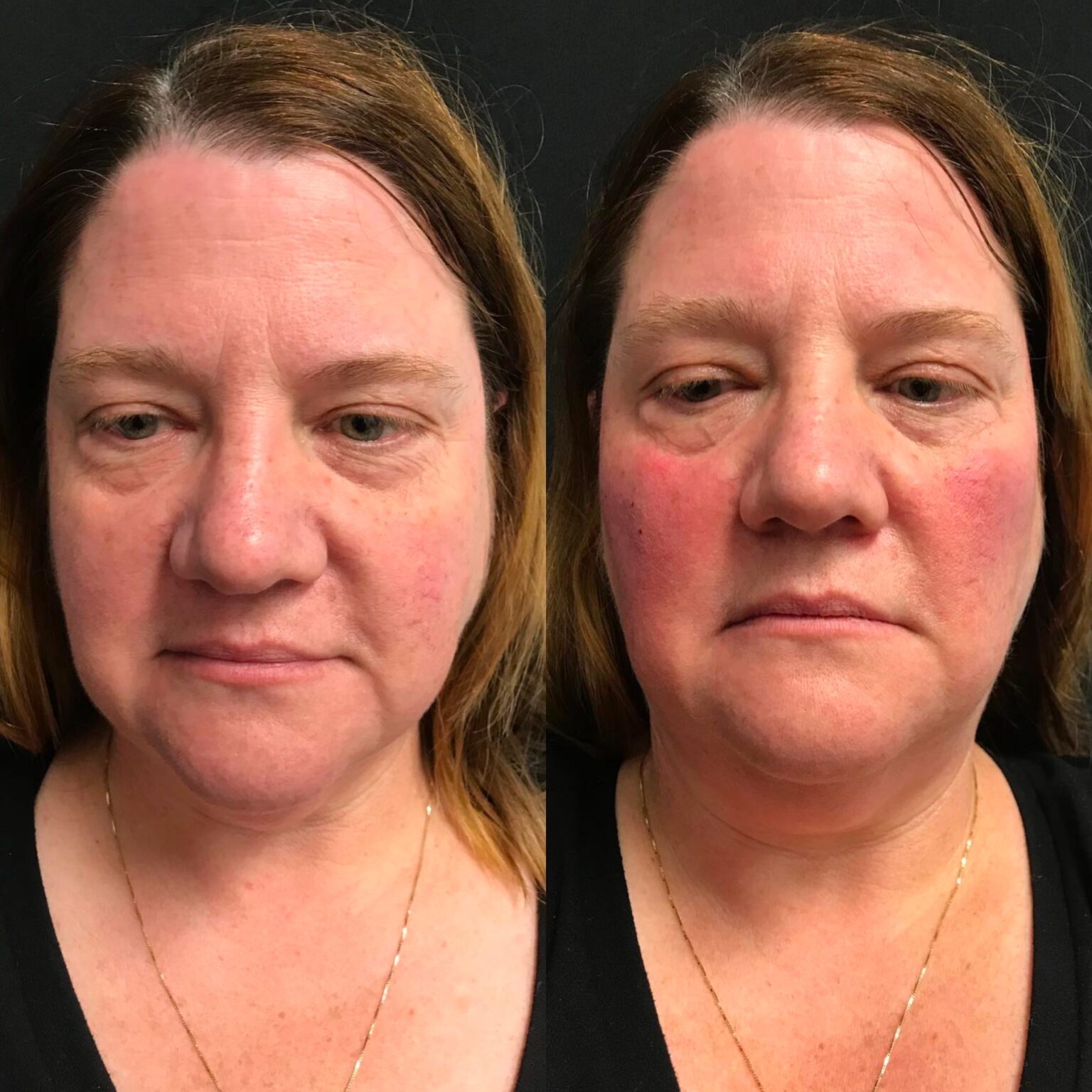 Cheek Filler 1 - Radiant Divine Medical Spa