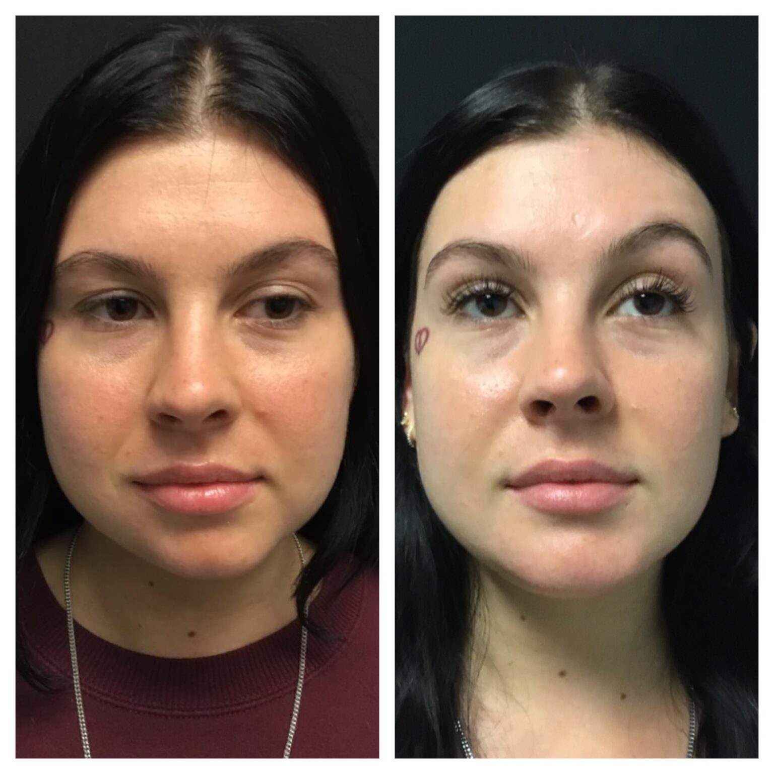 Facial Contouring 1 - Radiant Divine Medical Spa