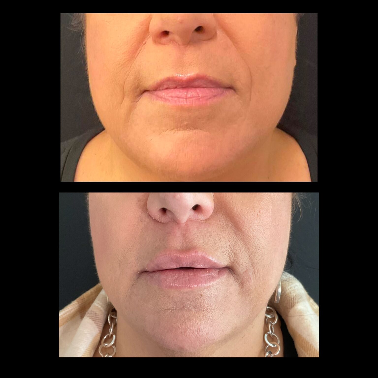 Facial Contouring 3 - Radiant Divine Medical Spa