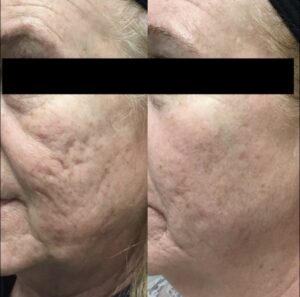 Skin Remodeling in Brecksville | Radiant Divine Medical Spa