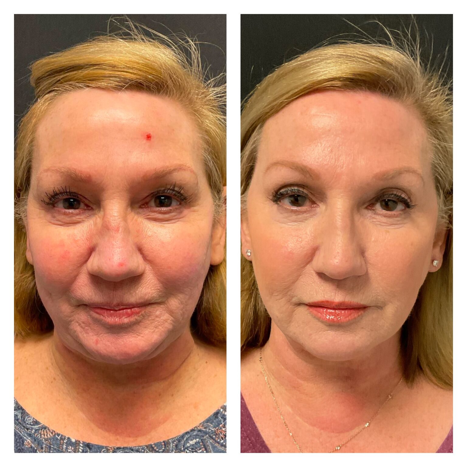 Skin Tightening (Face) 1 - Radiant Divine Medical Spa