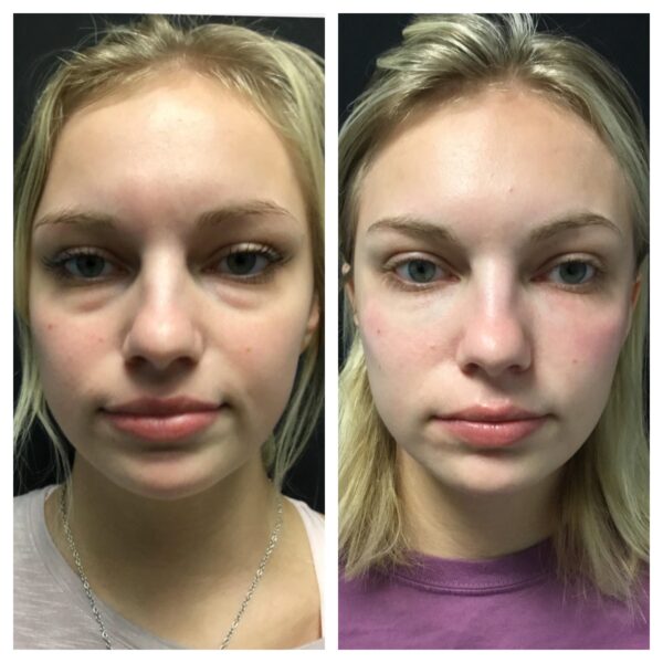 Tear Trough / Under Eye Correction 2 - Radiant Divine Medical Spa