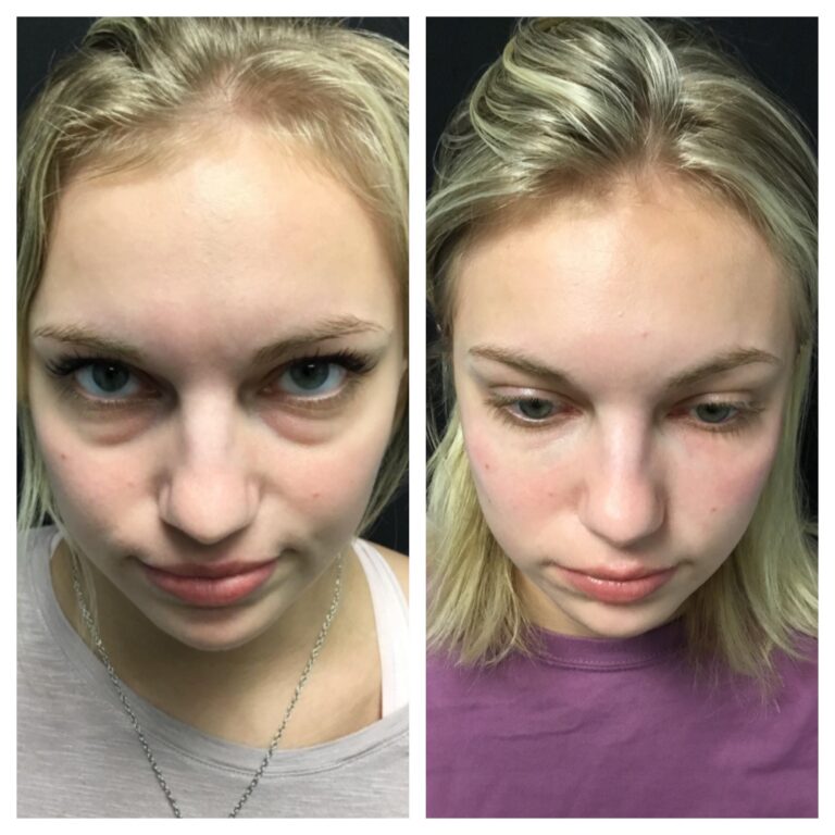 Tear Trough / Under Eye Correction 3 - Radiant Divine Medical Spa