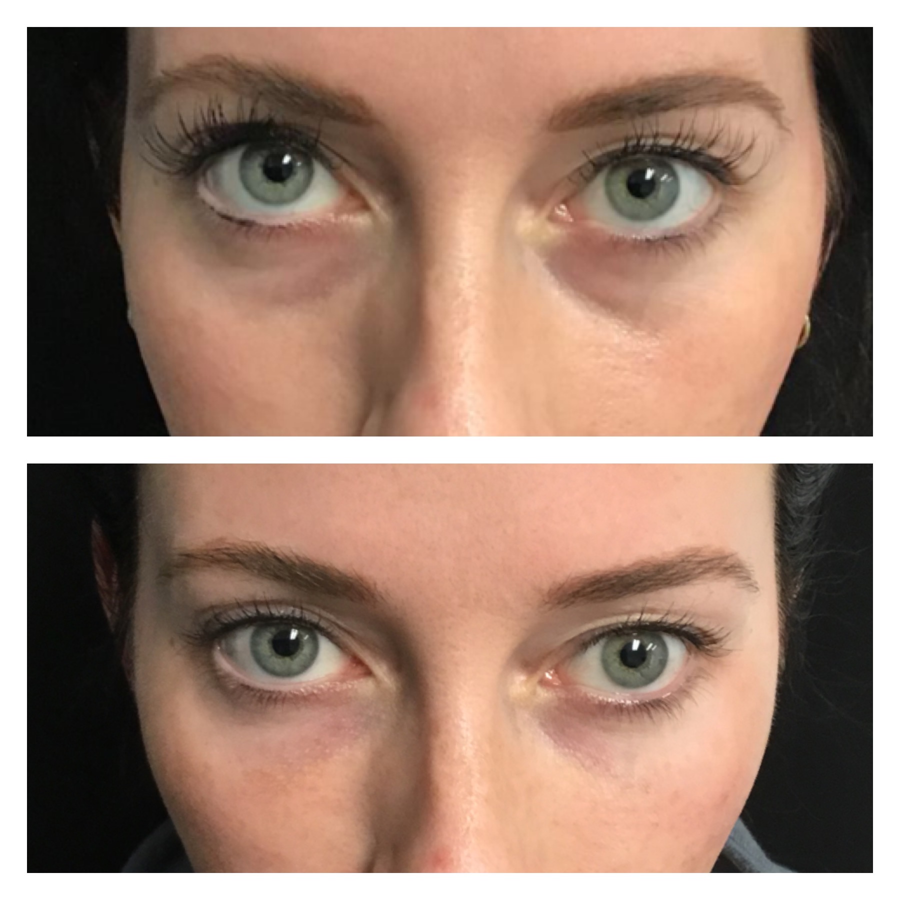 Tear Trough / Under Eye Correction 4 - Radiant Divine Medical Spa