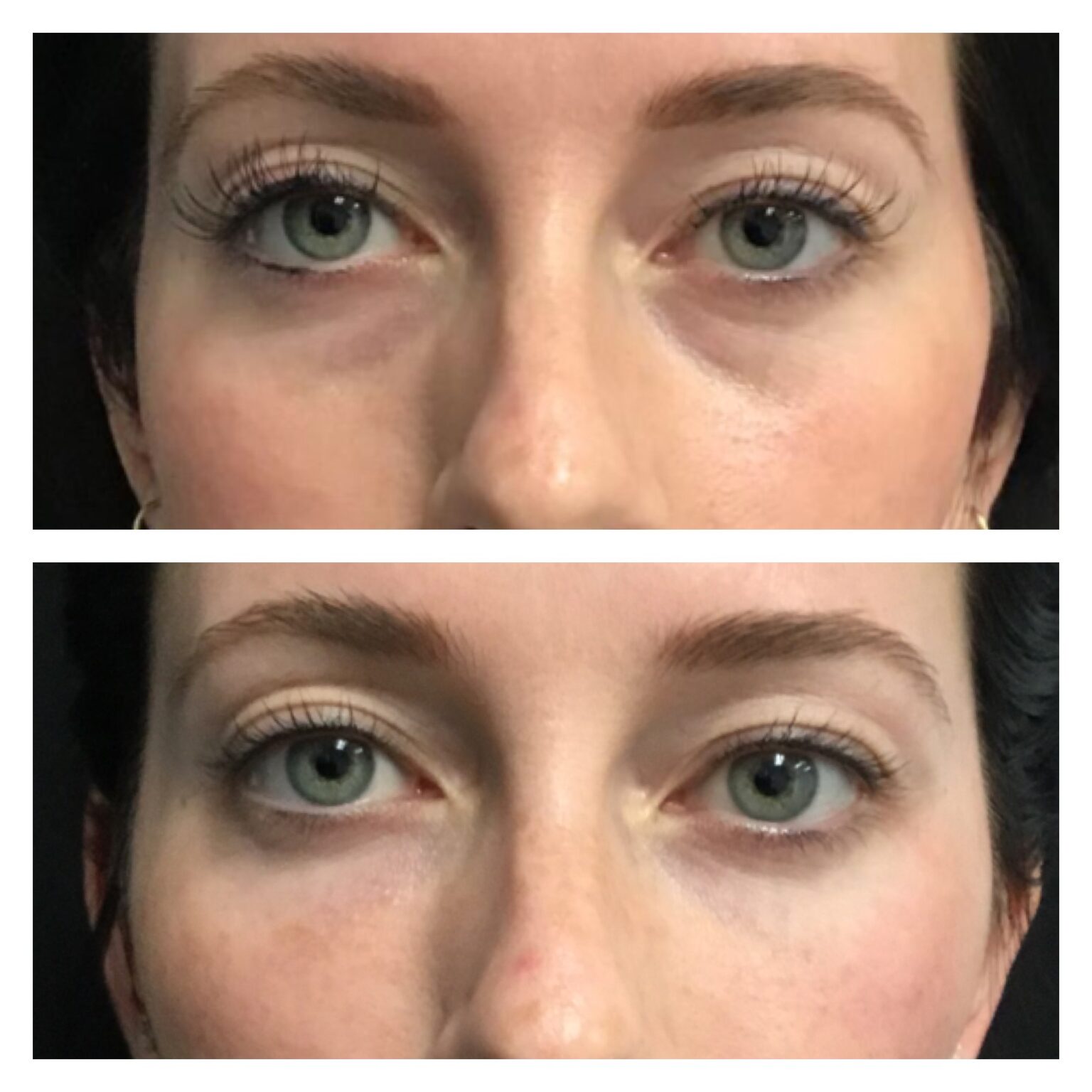 Tear Trough / Under Eye Correction 5 - Radiant Divine Medical Spa