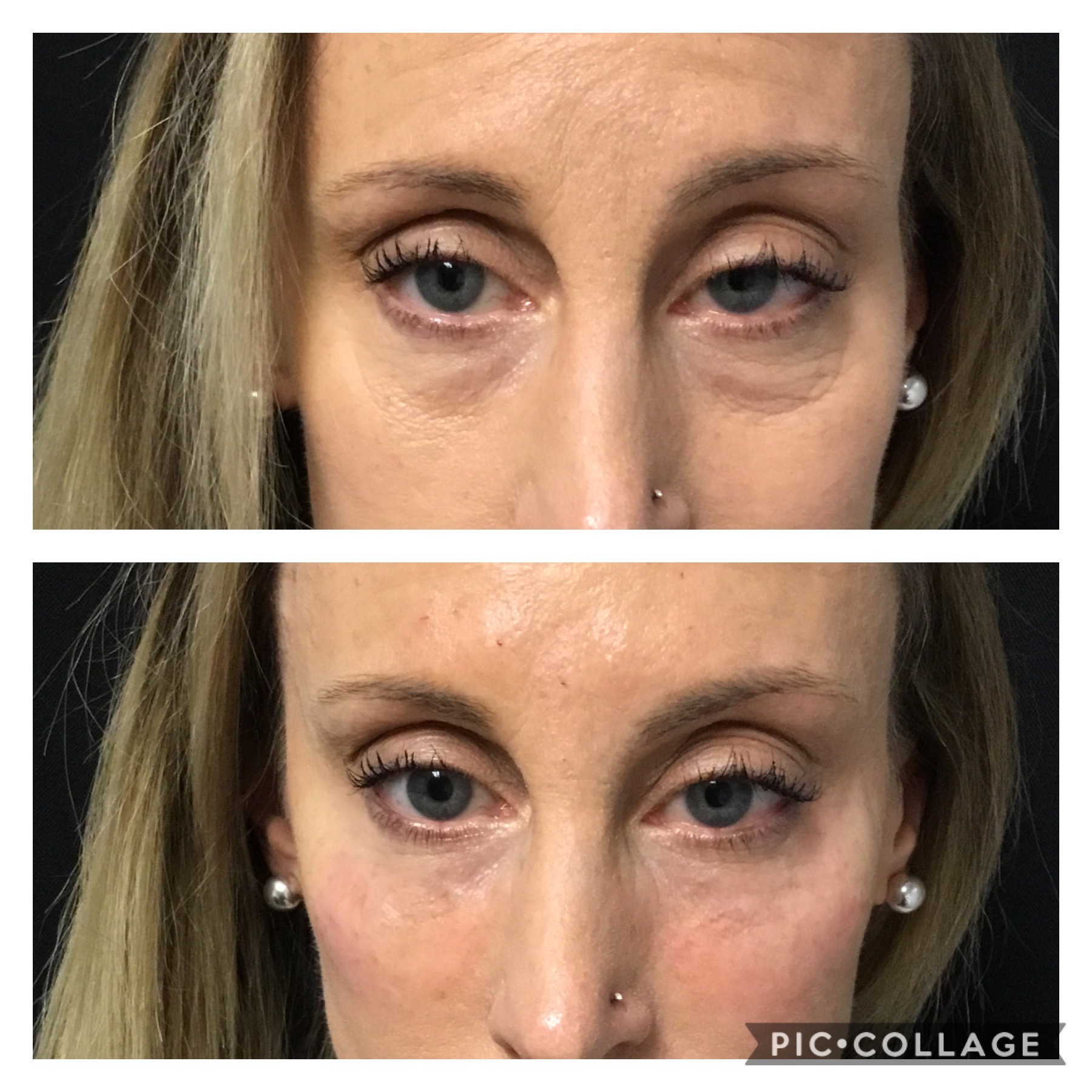 Tear Trough / Under Eye Correction 7 - Radiant Divine Medical Spa