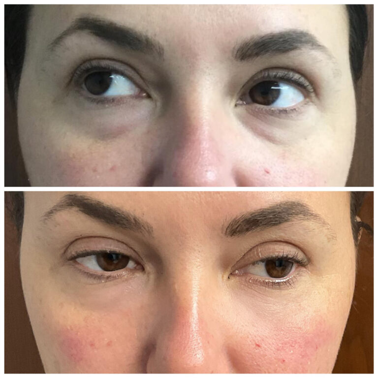 Tear Trough / Under Eye Correction 8 - Radiant Divine Medical Spa