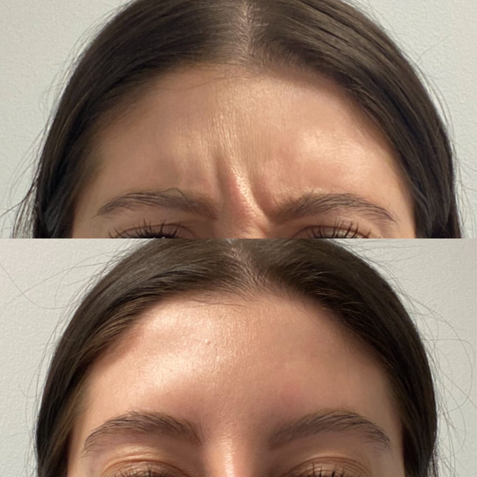 Wrinkle Relaxer 2 - Radiant Divine Medical Spa