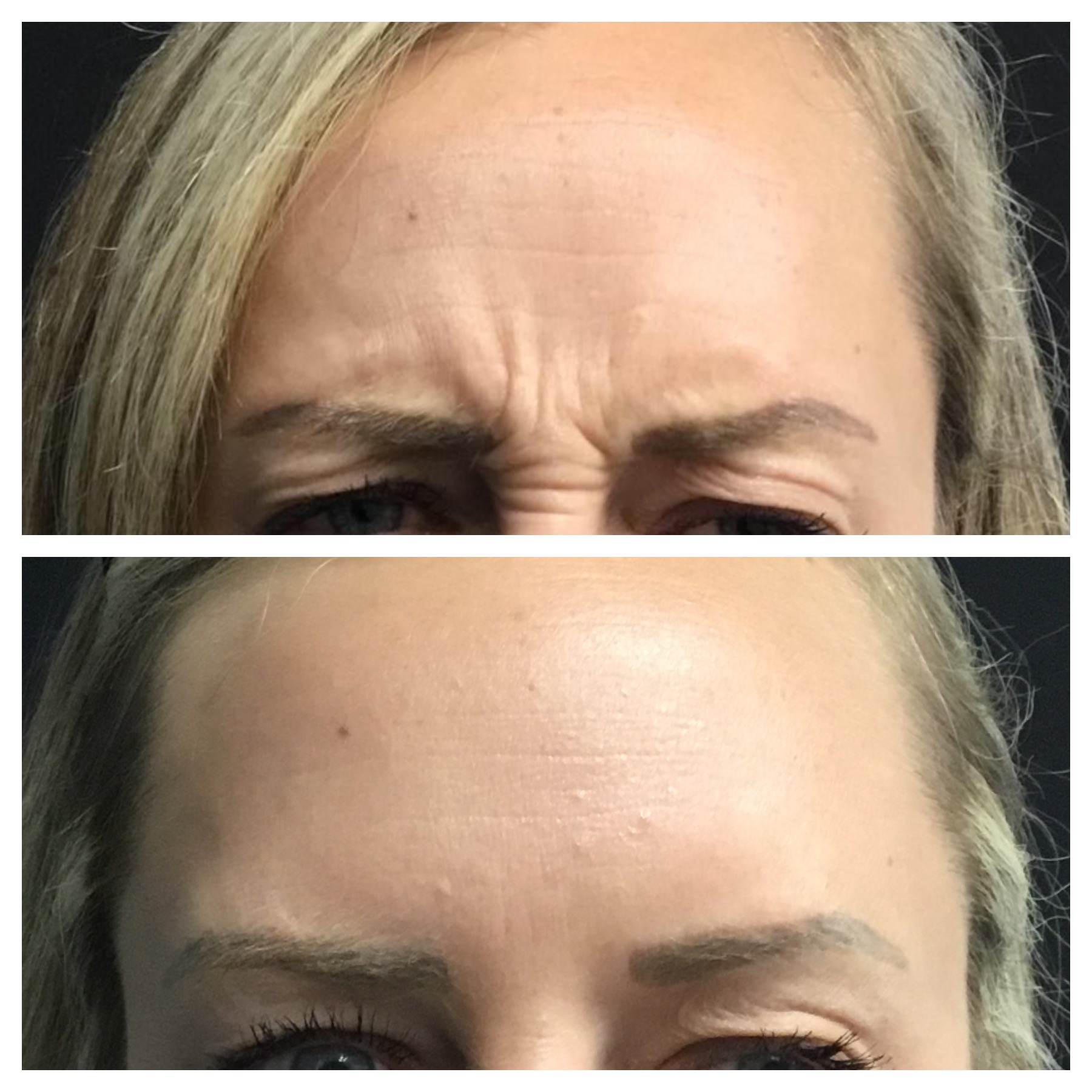 Botox Injections in Medina | Radiant Divine Medical Spa